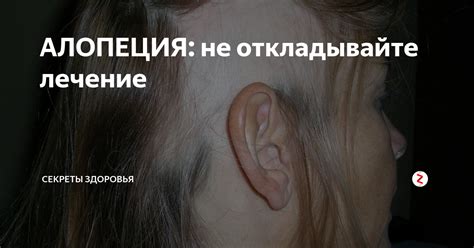 АЛОПЕЦИЯ: не откладывайте лечение | СЕКРЕТЫ ЗДОРОВЬЯ | Дзен