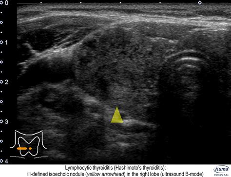 Pathology Outlines Hashimoto Thyroiditis