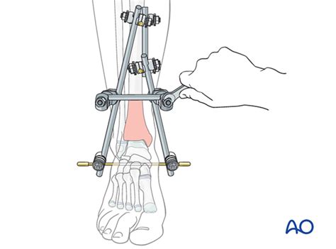 External Fixation For Complex Epi Metaphyseal Fractures Of The Distal Tibia Triplane