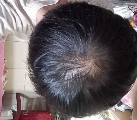請問我這樣算髮旋禿嗎? 美髮板 Dcard 請問我這樣算髮旋禿嗎? 美髮板 Dcard