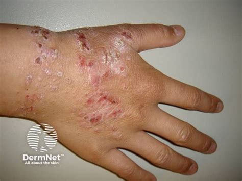 Dermnet Nz Dermnet Dermnetnz X Dermnet Nz Dermnet Dermnetnz X
