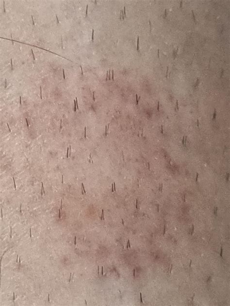 Unknown Rash On Shin Rdermatologyquestions