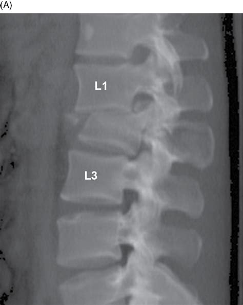 Transverse Process Fracture X Ray