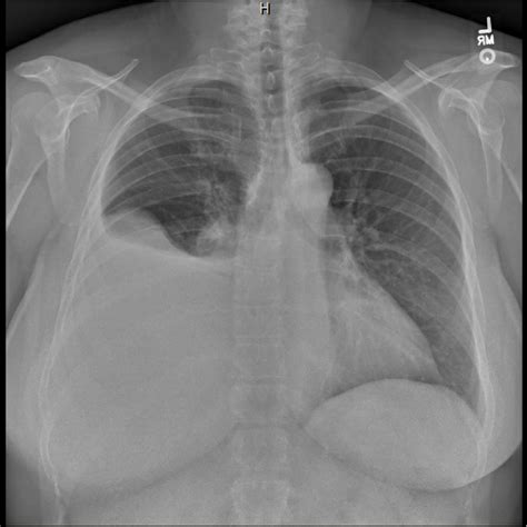 Pleural Effusion Chest Xray
