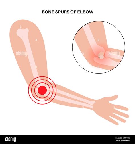 Illustration Of Elbow Arthroscopy Surgery This Is A Procedure For