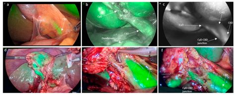 Intravenous Icg Injection A Initial View Of Icg Cholangiography