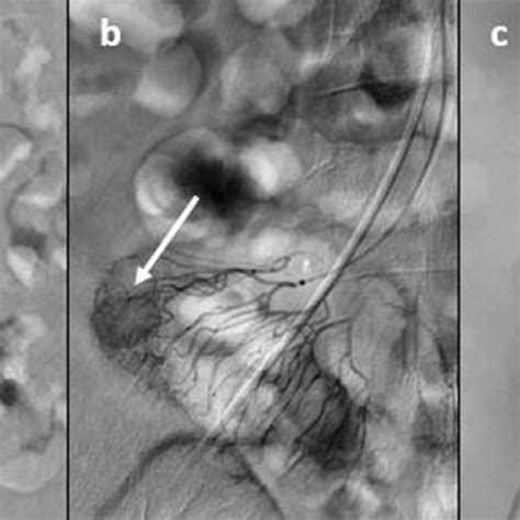 42 Years Old Woman With Sle Angiographic Super Selective Acquisitions