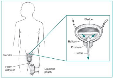 Prostate Enlargement Benign Prostatic Hyperplasia Niddk