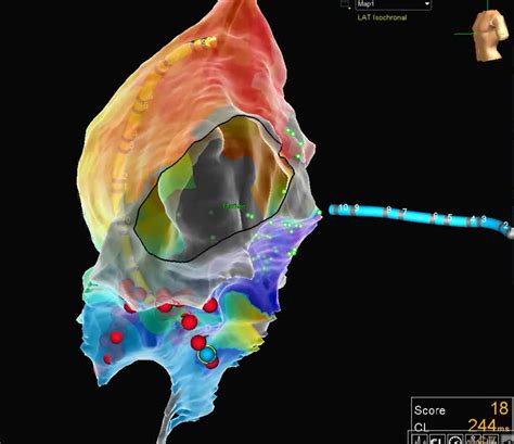 Stefan Andric On Linkedin Atrial Flutter After Tricuspid And Mitral Valve Ring Annuloplasty