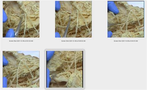 Smith Superficial Infratemporal Dissection Diagram Quizlet