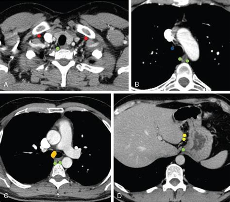 Imaging Of Metastasis Radiology Key