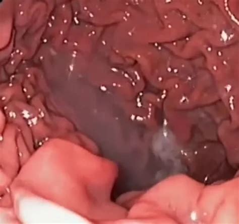 Endoscope Stomach Giantess Vore Full Tour