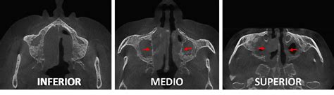 Sinusitis Crónica Con Osteítis Esclerosante Dento Metric Radiología Dental Oral Y Maxilofacial