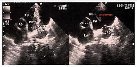 2d And Color Flow Echo Frames Showing Patent Ductus Arteriosus Pda Download Scientific