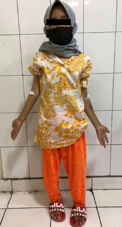 Short Stature And Cubitus Valgus Deformity Download Scientific Diagram