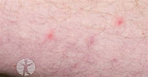 Behçet Disease Image