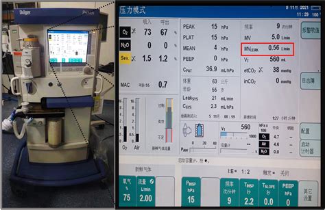 The Air Leakage During Lma Ventilation Is Detected By The Primus