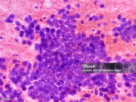 비소 세포 암종의 일종 인 선암을 보여주는 폐 세포학의 현미경 사진 암종에 대한 스톡 사진 및 기타 이미지 Istock