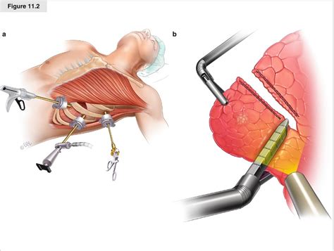 Vats Wedge Resection Thoracic Key