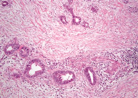 Pathology Outlines Gallbladder Carcinoma