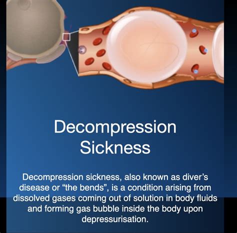 Hyperbaric Oxygen Therapy For Decompression Sickness Pretoria