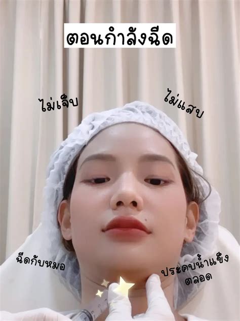 ฉีดหน้าราคาแค่ 1 Xxx บาท ลดหน้าบานแก้มเยอะ ‼️ แกลเลอรีที่โพสต์โดย เข้าเขตรีวิว⚠️ Lemon8