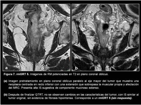 Figure 7 from Gradación de la respuesta del cáncer de recto tras neoadyuvancia | Semantic Scholar