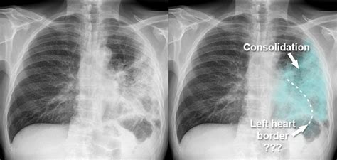Atypical Pneumonia