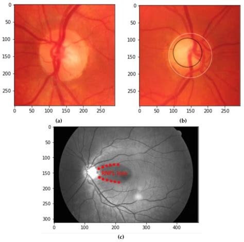 Retinal Nerve Fiber Layer Analysis Using Deep Learning To Improve Glaucoma Detection In Eye