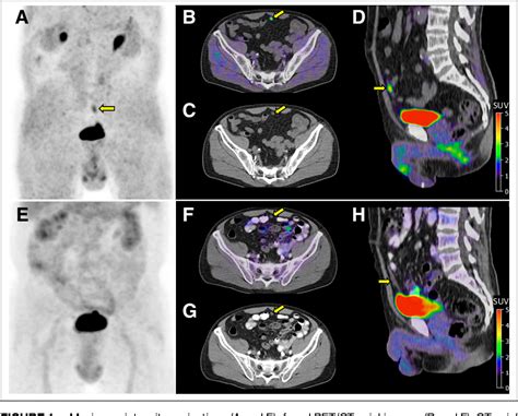 Figure 1 From Incidental Focal 68ga Fapi 46 Uptake In A Urachal Remnant