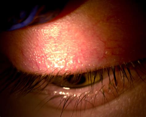 Ojo Seco Y Blefaritis Instituto De Oftalmología Láser De Cáceres