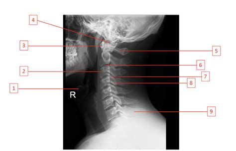 Diagram Of Lateral C Spine Quizlet