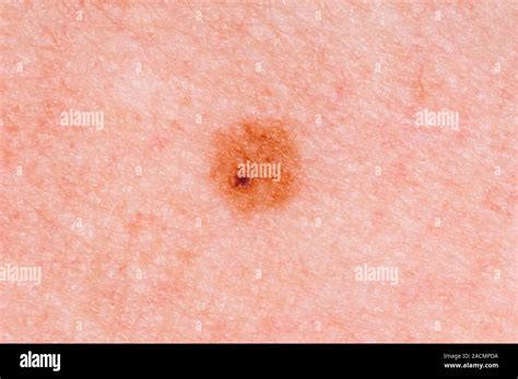 Junctional Naevus Mole On The Skin Stock Image C013 Junctional Naevus