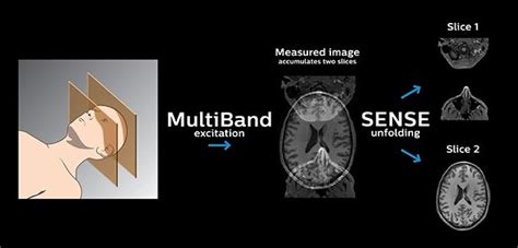 Multiband Sense Widens Possibilities Fmri Dmri Brain Fieldstrength