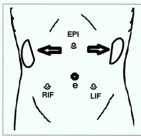 Figure 1 From Simultaneous Bilateral Laparoscopic Nephrectomy In A