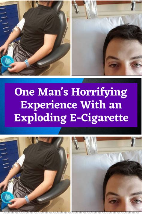 One Man S Horrifying Experience With An Exploding E Cigarette Artofit