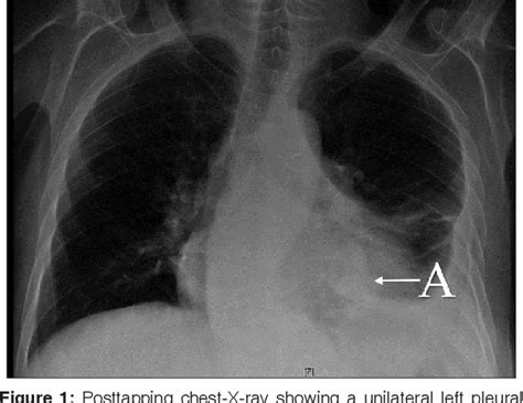 Figure 3 From Caseous Mitral Annular Calcification Mimicking A Lung Tumor On Chest X Ray
