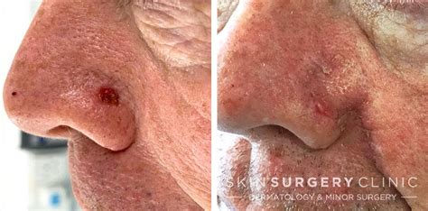 Basal Cell Carcinoma BCC Skin Cancer Removal Leeds Bradford Before And