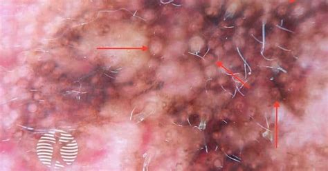 Concentric Circles Red Arrows Seen In Dermoscopy Of Lentigo Maligna