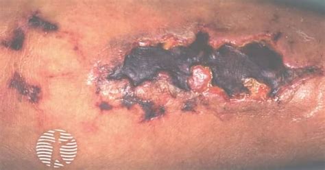 Calciphylaxis Image