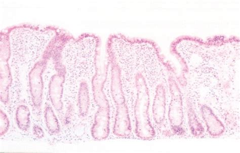 Crypt Hyperplasia Atrophia Vili Intestinales Download Scientific