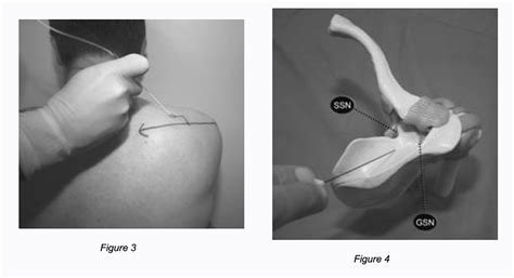 Suprascapular Nerve Block And Axillary Nerve Block