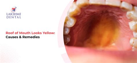 Yellow Patches Mucosa Oral White Oral Lesions That Need Your Attention