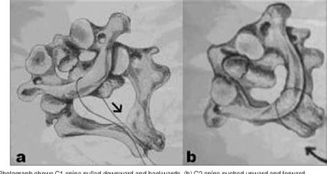 Figure 1 From Odontoid Fractures A Retrospective Analysis Of 53 Cases Semantic Scholar