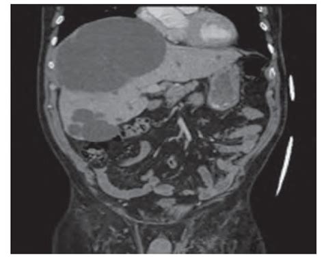 Not A Simple Cyst Hepatic Cyst Causing Intra Cardiac Shunti Official Journal Of The
