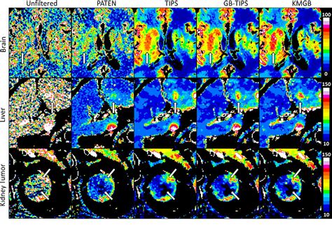 Figure 10 From Noise Reduction And Functional Maps Image Quality Improvement In Dynamic Ct