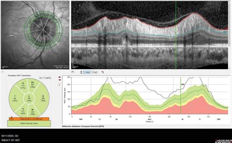 Normal Optic Nerve Vs Papilledema