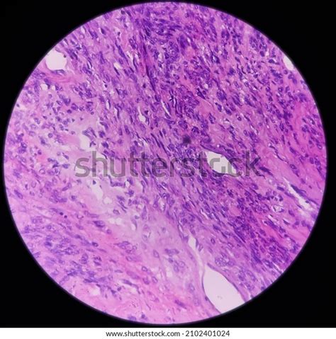 Стоковая фотография 2102401024 Fibroid Uterus Leiomyoma Myoma Known