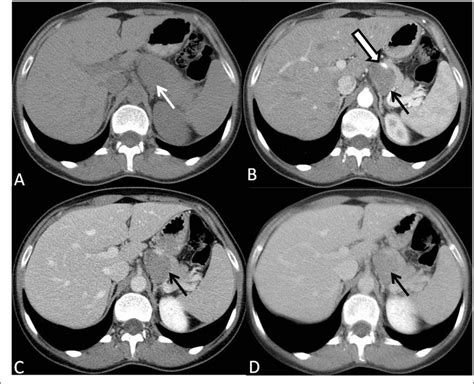 35 Year Old Women With A Solid Pseudopappilary Tumor Axial Ct Scans Download Scientific