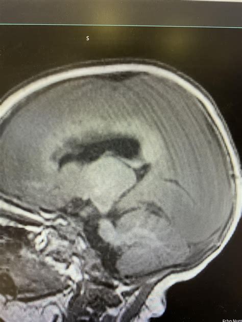 Smooth Brain Rradiology